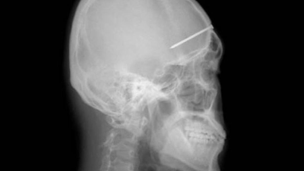 4 Foto Rontgen Ini Bikin Ngilu, Ada yang Tertancap di Kepala - Citizen6 ...