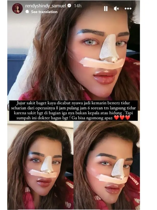 Setelah Operasi Bariatrik, Ini 6 Potret Shindy Samuel yang Kini Jajal Oplas Hidung - Hot ...