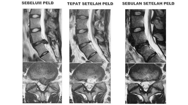 Solusi Tepat Mengatasi Masalah Saraf Kejepit - Health Liputan6.com