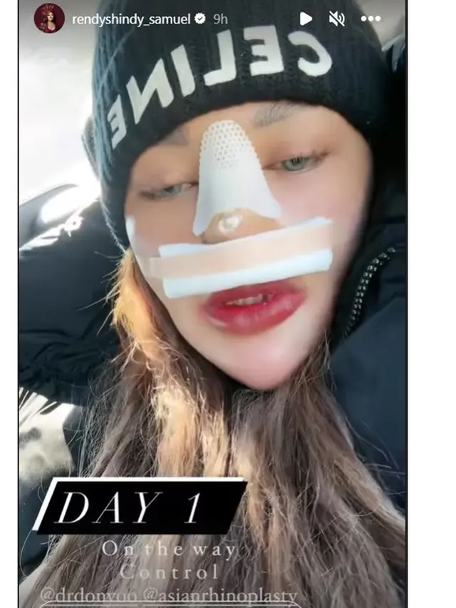 Setelah Operasi Bariatrik, Ini 6 Potret Shindy Samuel yang Kini Jajal Oplas Hidung - Hot ...