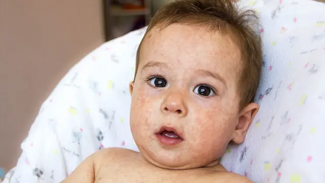 Biang Keringat pada Bayi Bisa Jadi Infeksi, Ketahui 6 Cara Mengatasinya - Hot Liputan6.com