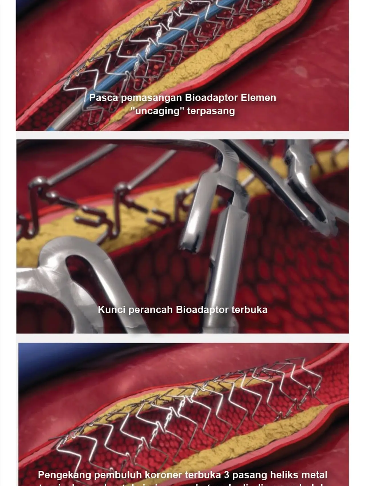 Teknologi Stent Bioadaptor Terbukti Efektif bagi Pasien Jantung Usia ...
