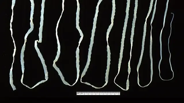 Ngeri! Wanita Ini Minum Pil Berisi Telur Cacing Pita Babi Demi Diet ...
