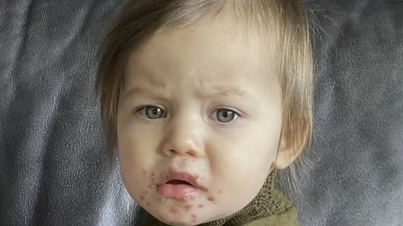 17 Jenis Gatal pada Kulit dan Gambarnya, Umum Diderita Semua Usia - Hot ...