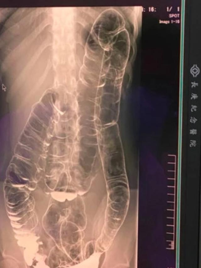 Sering Sembelit, Wanita Ini Syok Lihat Rontgen Usus Besarnya Sampai ke ...