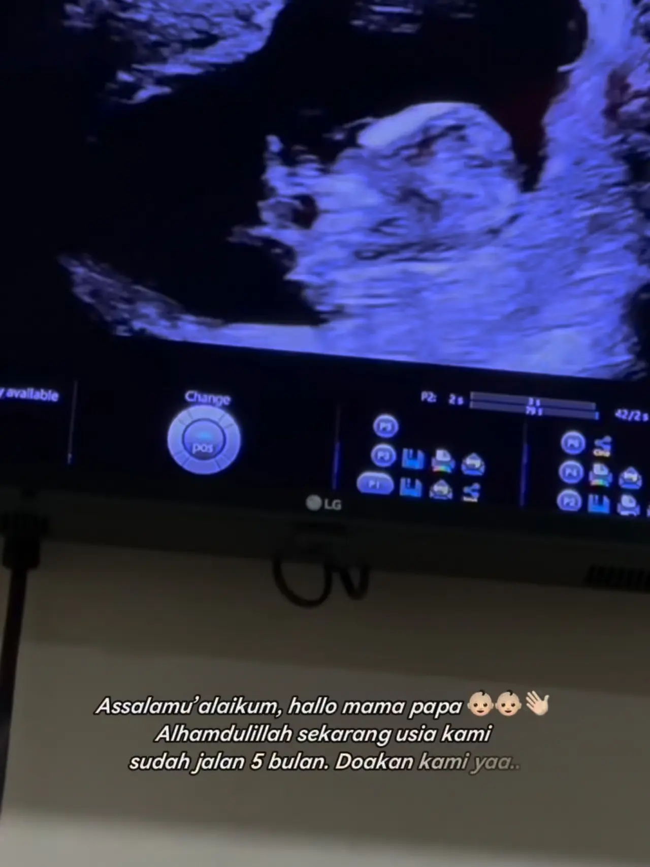 10 Potret Istri Dennis Lim Hamil Anak Kembar Setelah 5 Tahun, Jalani ...