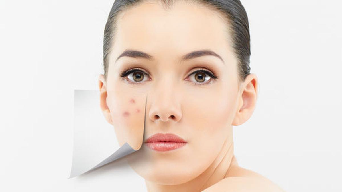 Tidak Ada Obat Penyakit Kulit Rosacea: Benarkah? - Beauty Fimela.com