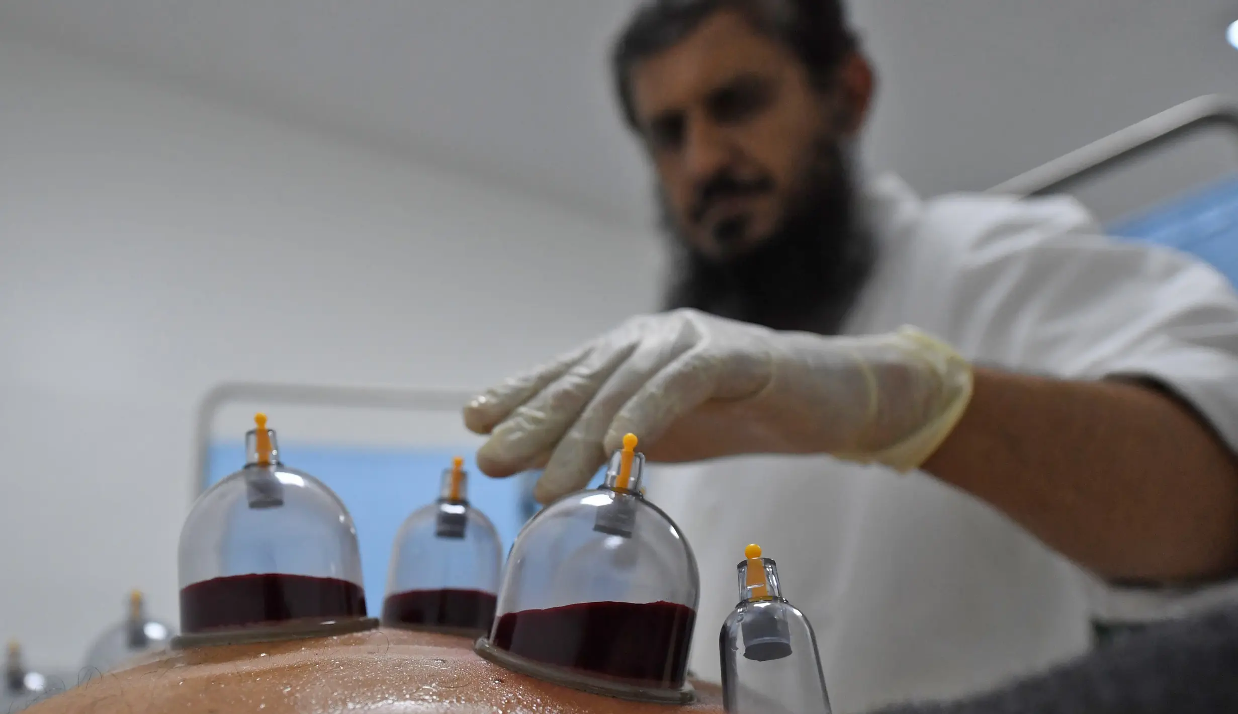 FOTO: Melihat Metode Bekam di Uni Emirat Arab - Foto Liputan6.com