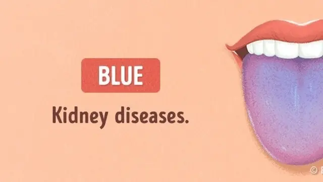 8 Warna Lidah yang Jelaskan Kondisi Kesehatan Anda - Health Liputan6.com