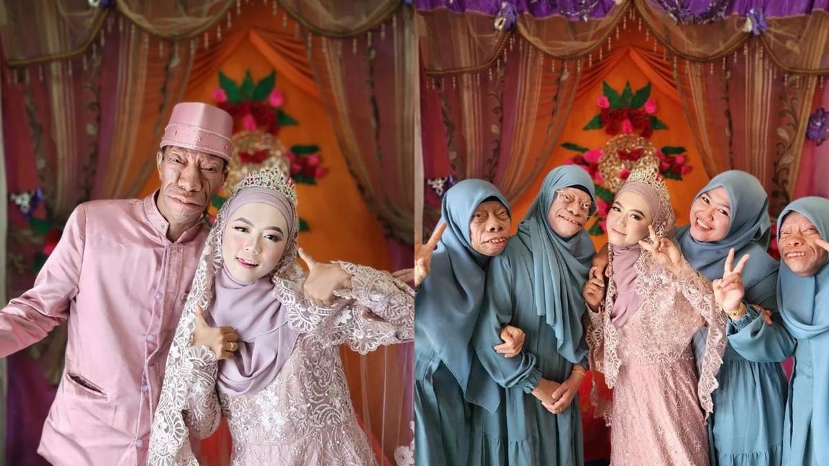 7 Potret Pernikahan Surya Manurung Pengidap Sindrom Langka, Banjir ...