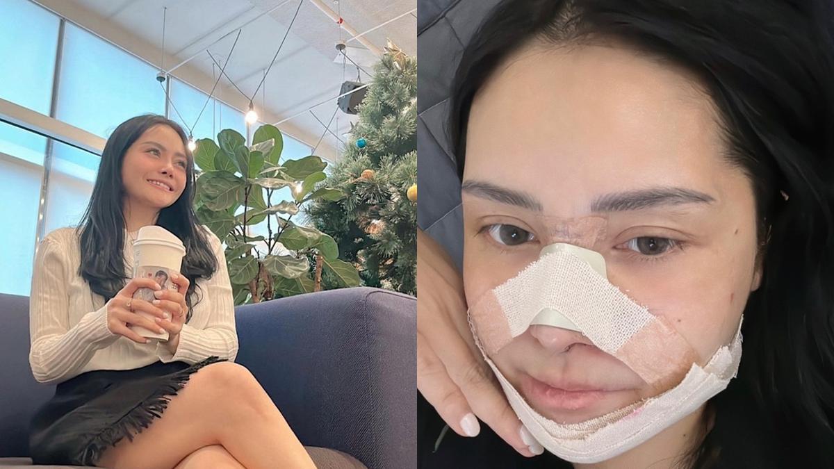 6 Potret Mawar AFI Oplas Hidung Kedua di Korea, Implan Pakai Tulang Iga