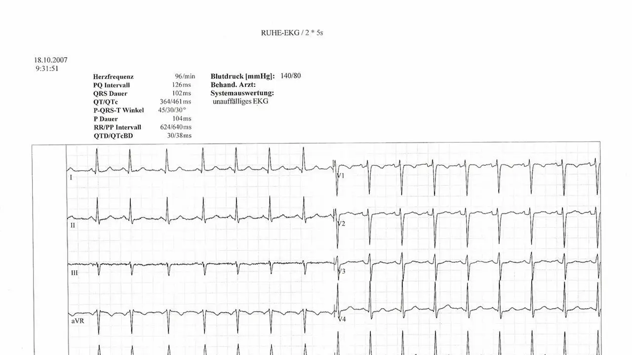 9 Cara Membaca EKG untuk Pemeriksaan Jantung, Pahami Tahapannya - Hot ...