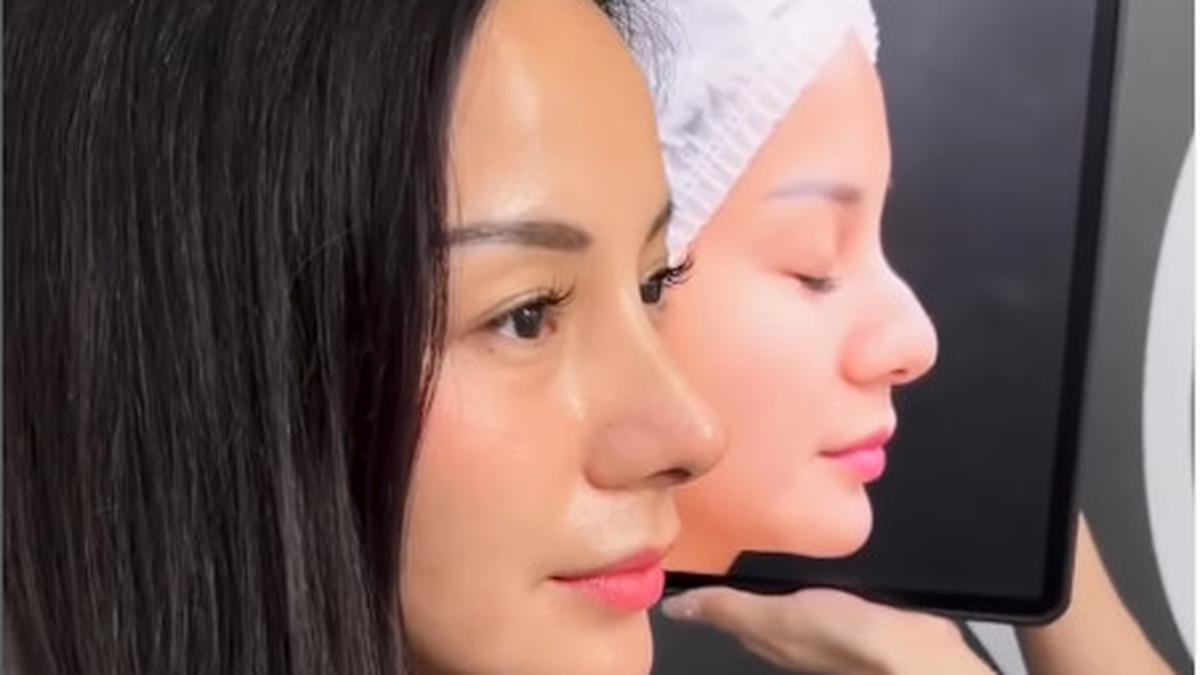 Kirana Larasati Bagikan Kisah Operasi Hidung di Thailand, Berikut ...
