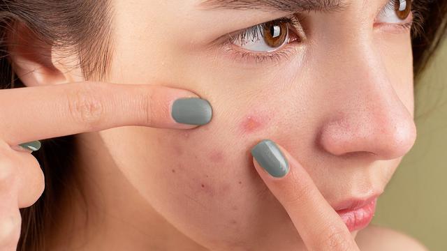 8 Cara Menghilangkan Bekas Jerawat dengan Bahan Alami, Mudah Dipraktikkan - Ragam Bola.com