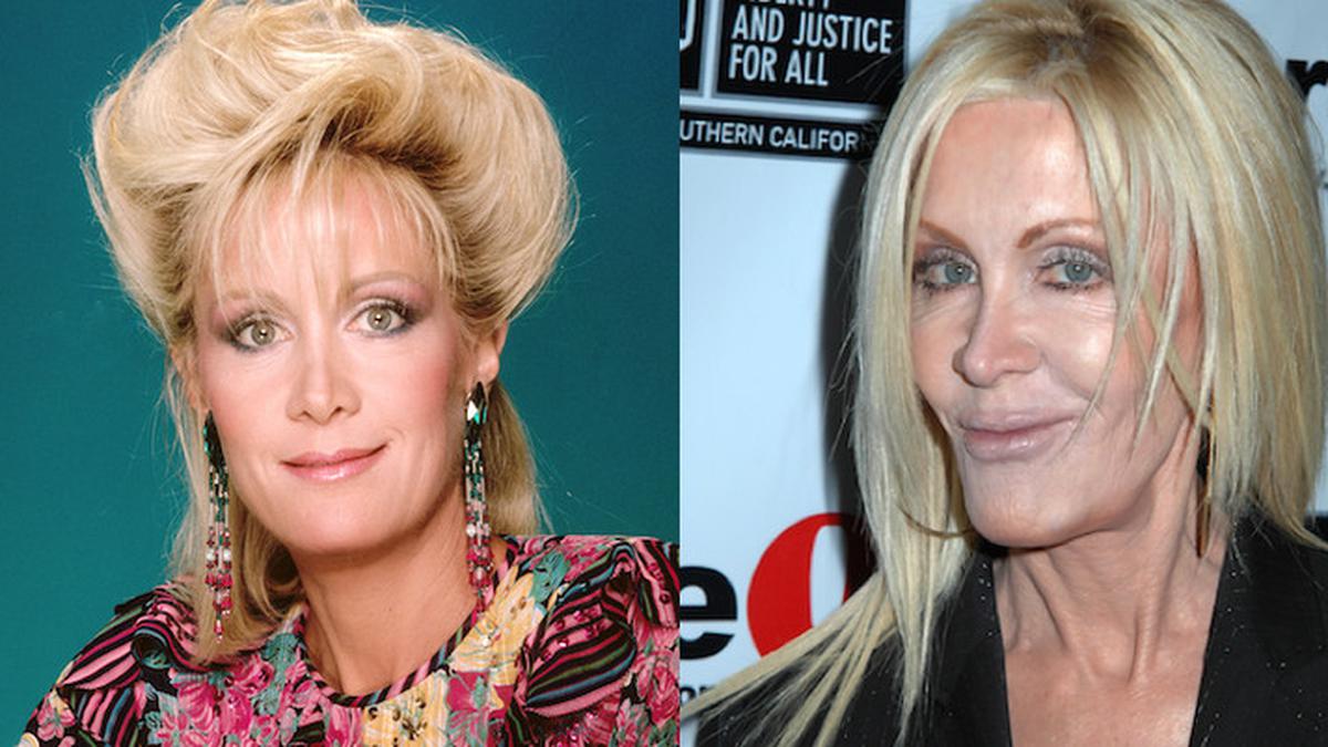 Operasi Plastik Gagal, 5 Muka Selebriti Hollywood Ini Aneh Banget