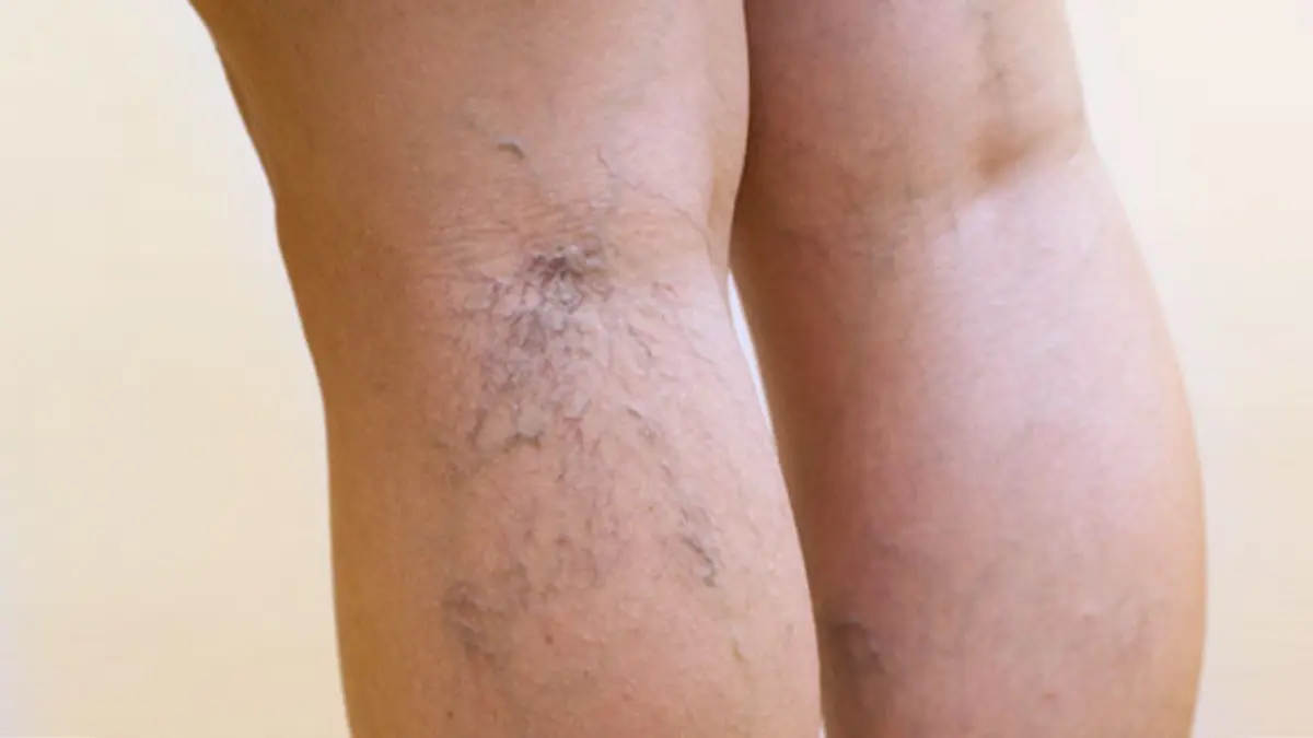 Berita Ciri-Ciri Varises Hari Ini - Kabar Terbaru Terkini | Liputan6.com