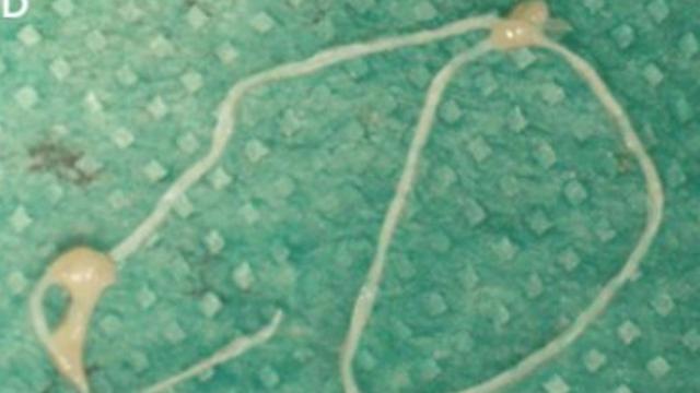 Top 3: Benjolan di Wajah Ternyata Cacing yang Hidup dan Bergerak ...