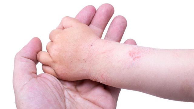 Eksim adalah Dermatitis, Ini Jenis-Jenis, Penyebab, dan Cara Mengatasinya - Hot Liputan6.com