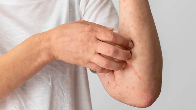 Cara Mengatasi Biduran beserta Penyebabnya - Ragam Bola.com