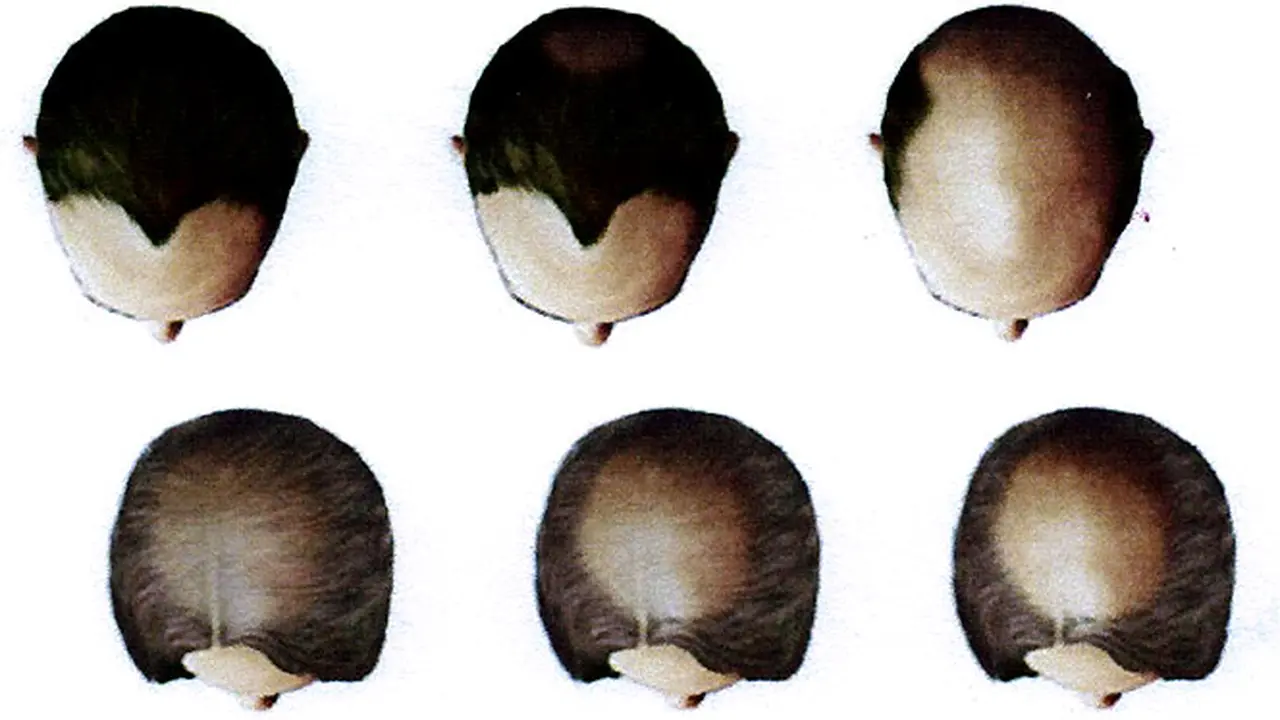 Macam-macam Kebotakan Pria dan Cara Menutupinya - Health Liputan6.com