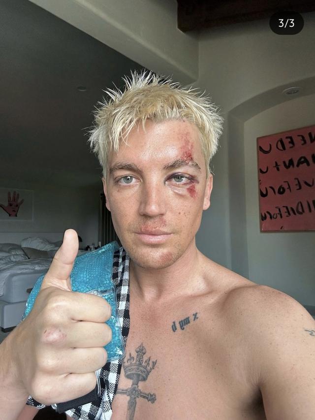 Vokalis LANY Paul Klein Jadi Korban Kecelakaan, Jadwal Tur Konser Diundur
