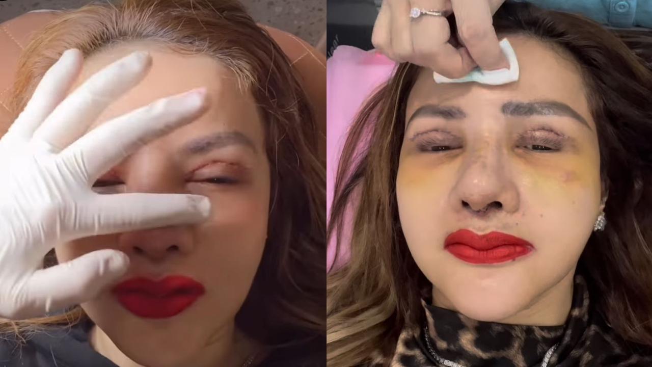 Barbie Kumalasari Operasi Plastik ke-9 Demi Mata ala Kylie Jenner ...