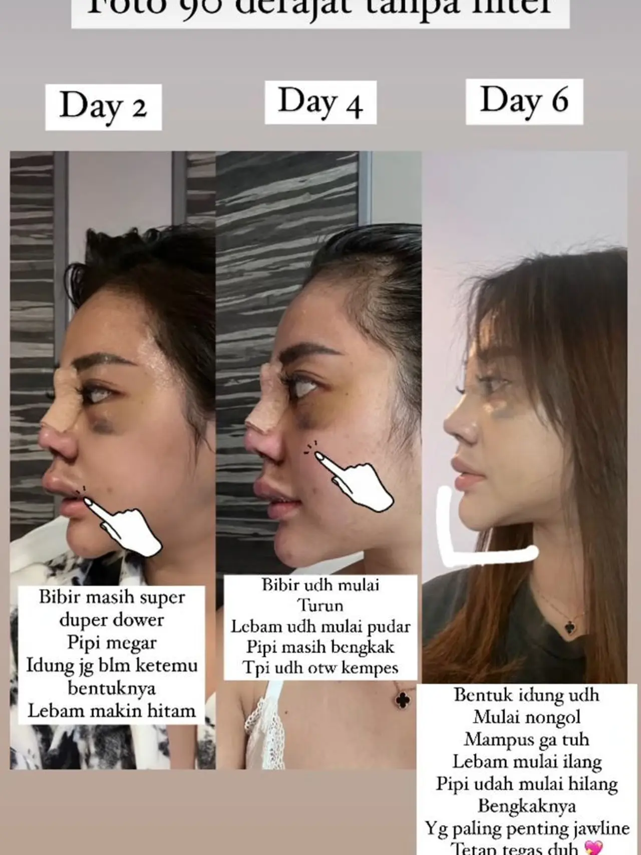 6 Potret Daniar MasterChef Usai Operasi Hidung, Jadi Sorotan - Hot ...