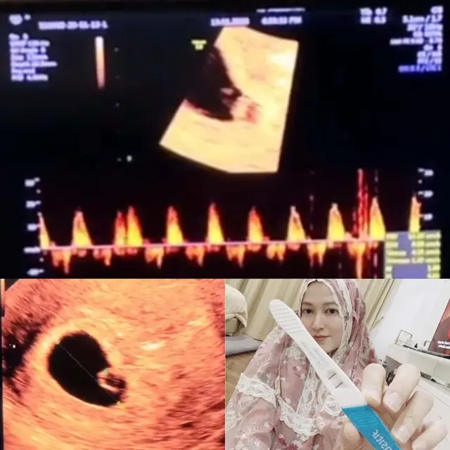 Hamil Setelah 7 Tahun Menanti, Ini 6 Momen Romantis Lyra Virna dan Fadlan - Hot Liputan6.com