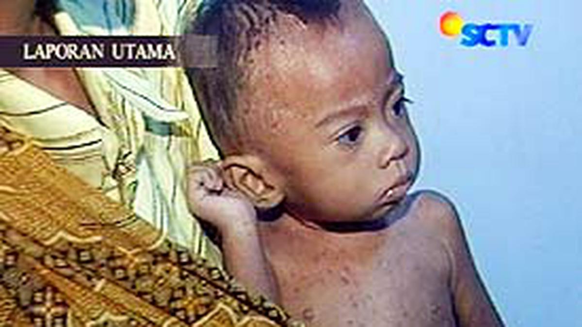 Penderita Busung Lapar di NTB Sangat Tinggi