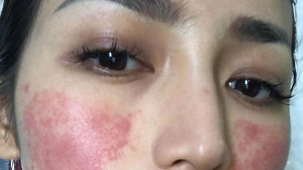 5 Fakta di Balik Bercak Merah pada Kulit Jessica Iskandar - ShowBiz ...