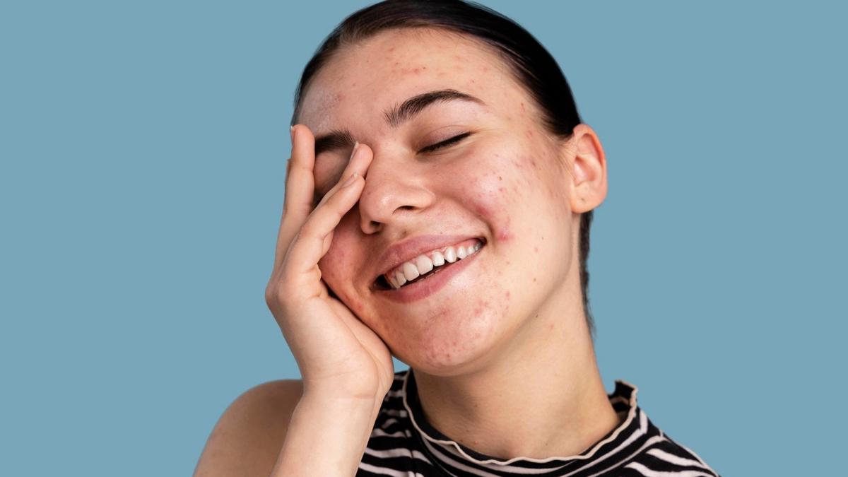 Cara Mengatasi Jerawat Tanpa Skincare dengan Alami, Efektif dan Aman