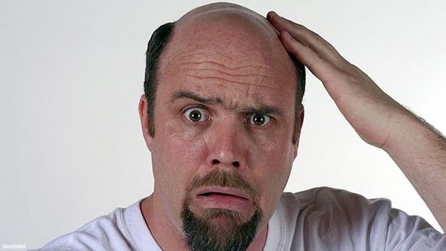 Kenapa Pria Cenderung Botak? - Health Liputan6.com