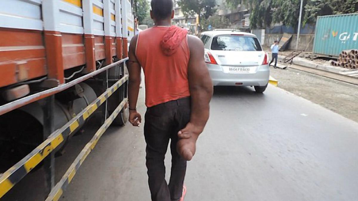 Pria Bertangan Raksasa Melawan Stigma 'Anak Setan' - Global Liputan6.com