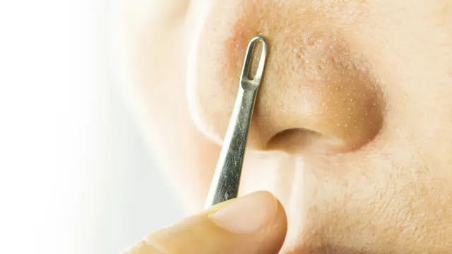 10 Cara Menghilangkan Komedo Hitam di Hidung Secara Alami dan ...