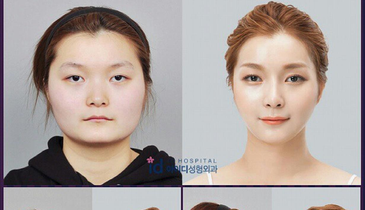 Before After Operasi Plastik Karya ID Hospital Korea Selatan - Photo ...