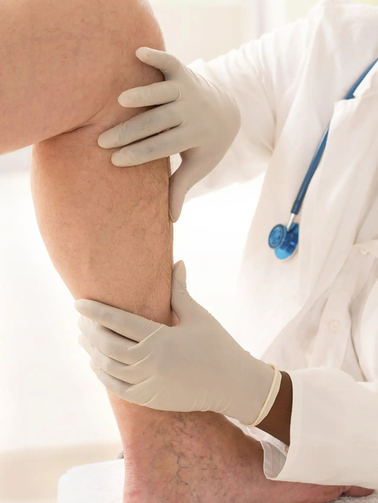 Bukan Hanya Mengganggu Penampilan, Kenali Gejala dan Dampak Varises ...