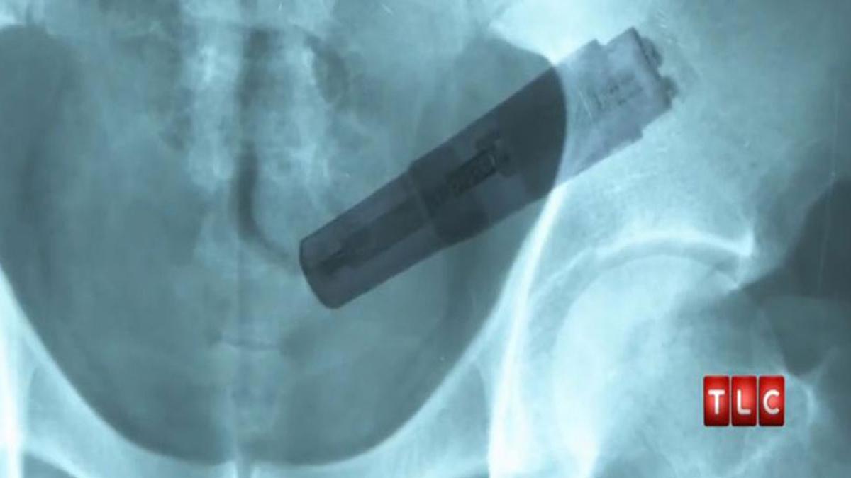 Pria Masuk UGD Gara-gara Vibrator Terjebak di Usus Besar - Health ...
