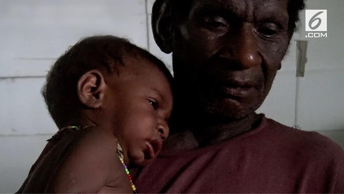 VIDEO: Campak dan Gizi Buruk Asmat Masuk Kejadian Luar Biasa - News Liputan6.com