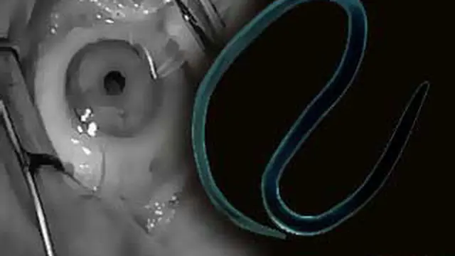 Astaga, Ada Cacing di Mata Pasien - Health Liputan6.com