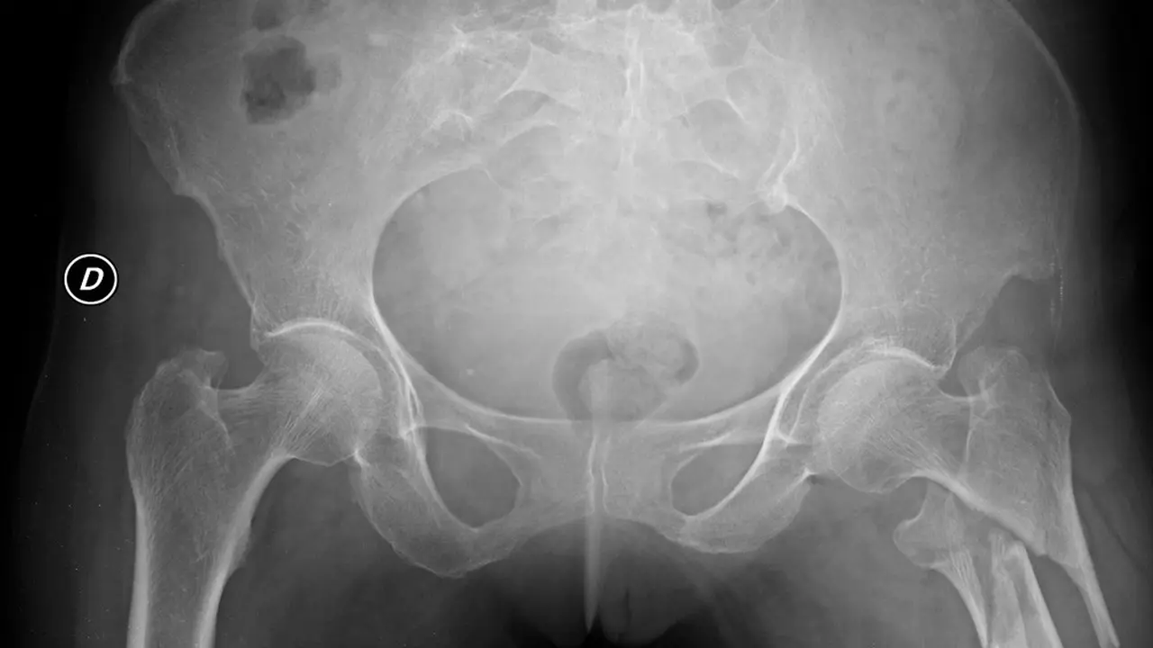 Kenali Teknik Hip Arthroscopy untuk Cidera Tulang Pinggul - Health ...