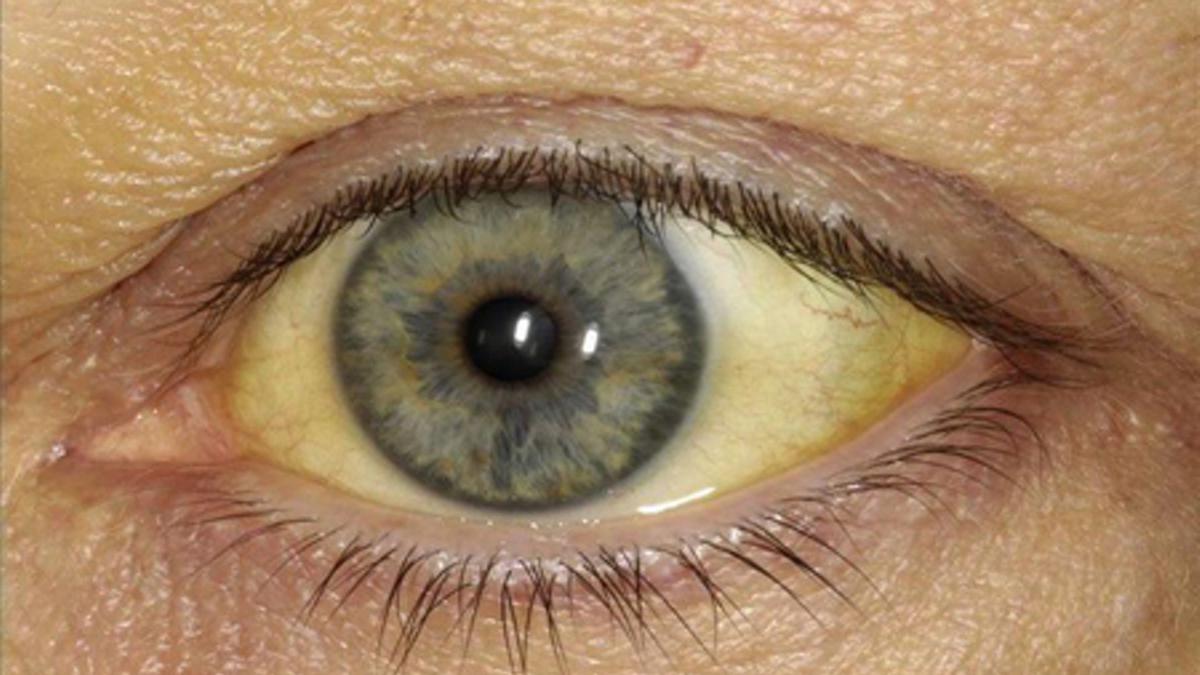 Waspada, Warna Mata Kuning Bisa Jadi Tanda Lever Bermasalah - Health ...