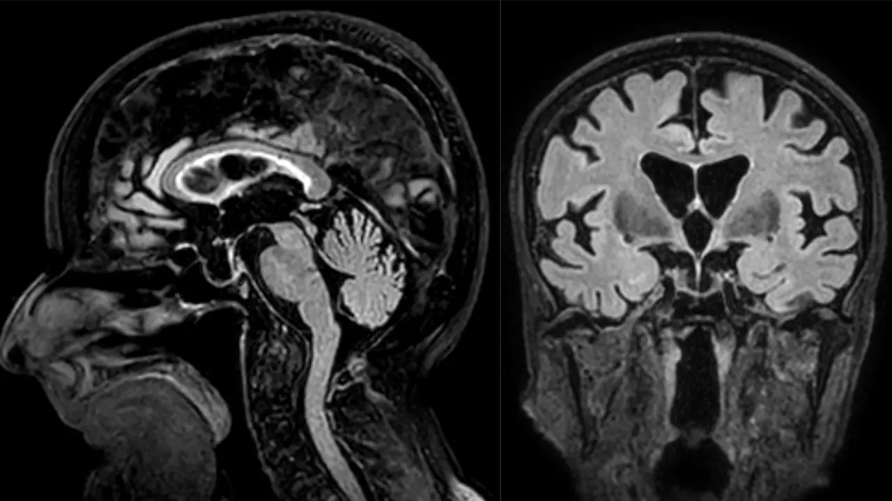 Mengenal Empty Sella Syndrome, Penyakit Langka yang Dapat Pengaruhi ...