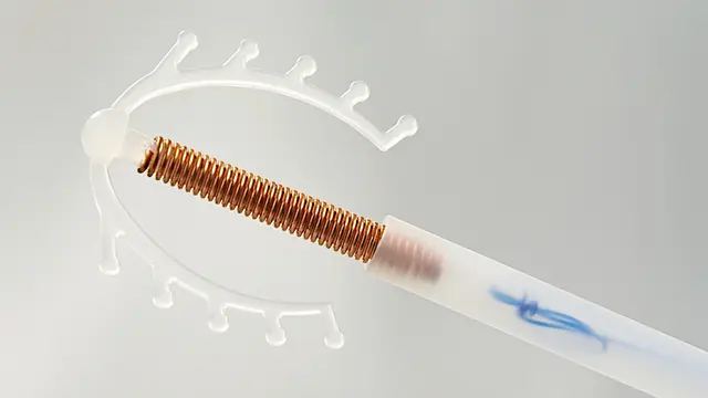 IUD Adalah Intrauterine Device, Pahami Kelebihan, Efek Samping, dan ...