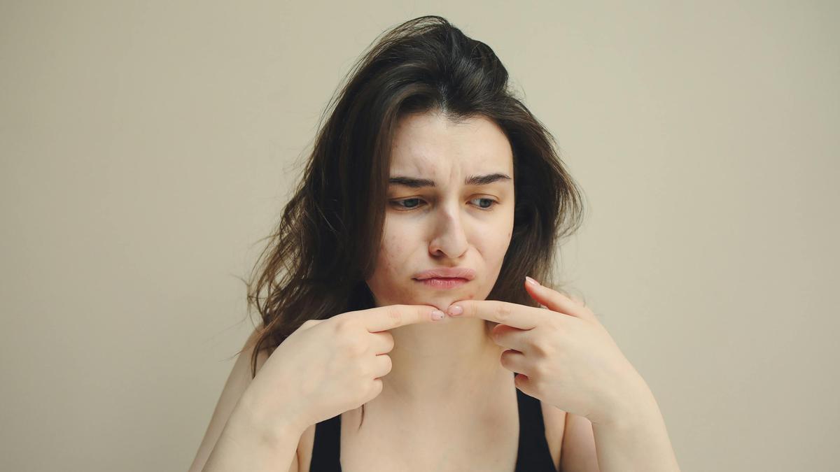 Tetap Slay Walau Ada Jerawat, Ini Tips Pakai Pimple Patch Agar Tidak ...