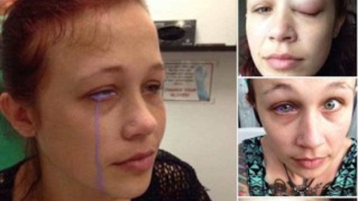 Lakukan Tato Bola Mata, Model Asal Kanada Ini Terancam Buta - Lifestyle ...