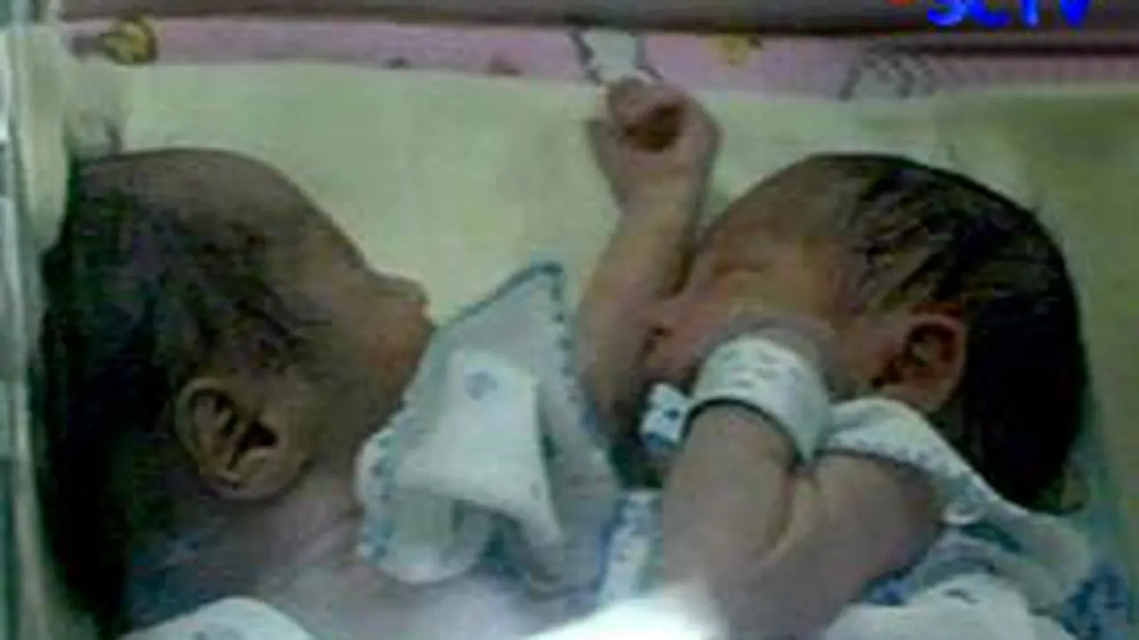 Kembar Siam Dempet Perut Lahir di Solo - News Liputan6.com