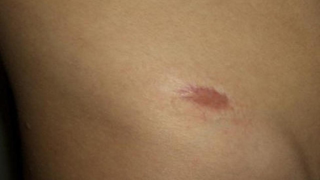 Keloid adalah Tumor Jinak, Ini Penyebab, Cara Menghilangkan, dan ...