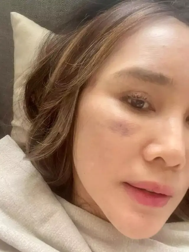 Potret Terbaru Ina Thomas Setelah Jalani Operasi Plastik di Korea Selatan, Disebut 20 Tahun ...