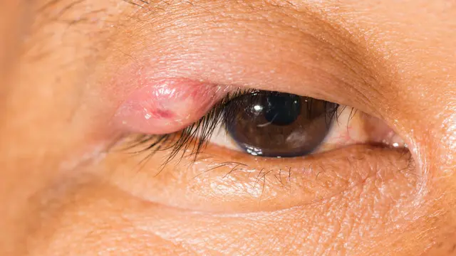 Curhat Perempuan 2 Kali Operasi karena Kalazion: Setop Memaksakan Pakai ...