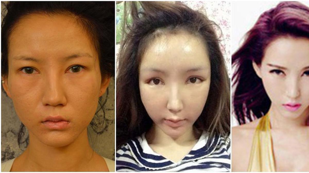 Aku Rela Sakit Karena Operasi Plastik, Demi Jadi Cantik